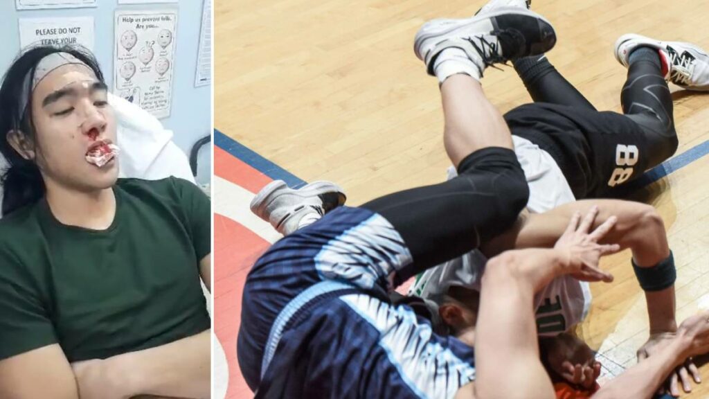 Oczon sustains broken nose, multiple stitches after bad crash vs Adamson